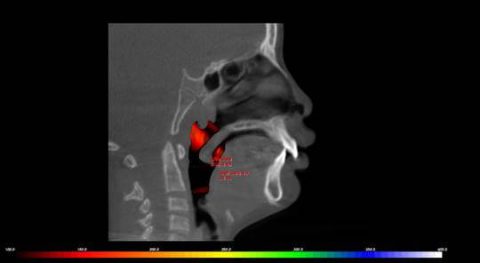 Child Airway - Hamilton & Manuele Orthodontics