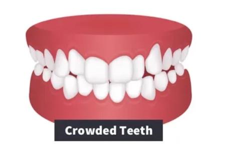 Maxillary Expansion for Kids - Hamilton & Manuele Orthodontics